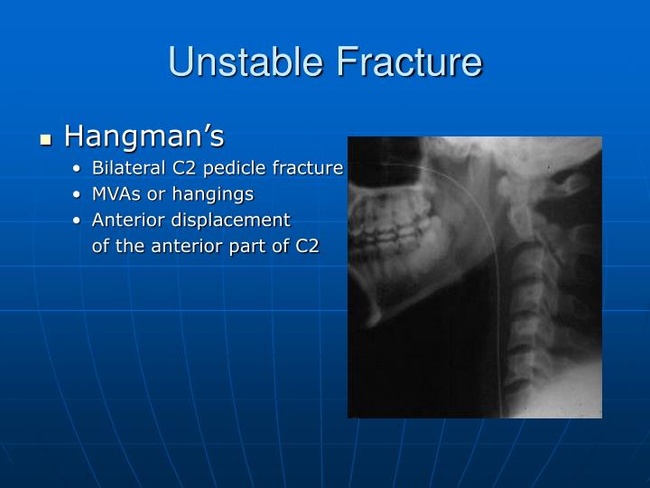 PPT - Cervical Spine PowerPoint Presentation - ID:732240