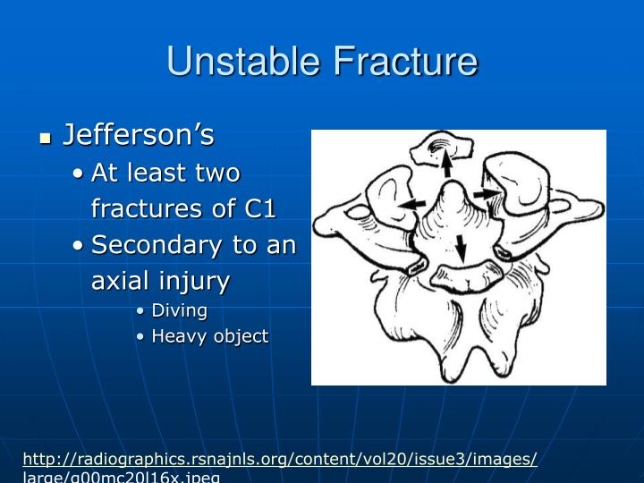 PPT - Cervical Spine PowerPoint Presentation - ID:732240
