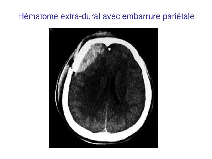 PPT - SEMIOLOGIE DES URGENCES NEUROLOGIQUES PowerPoint Presentation ...