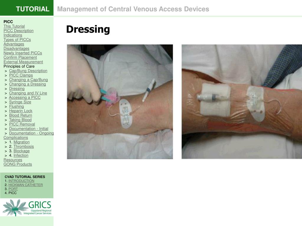 PPT - 4. PERIPHERALLY INSERTED CENTRAL CATHETER - PICC PowerPoint ... PPT - 4. PERIPHERALLY INSERTED CENTRAL CATHETER - PICC PowerPoint ...