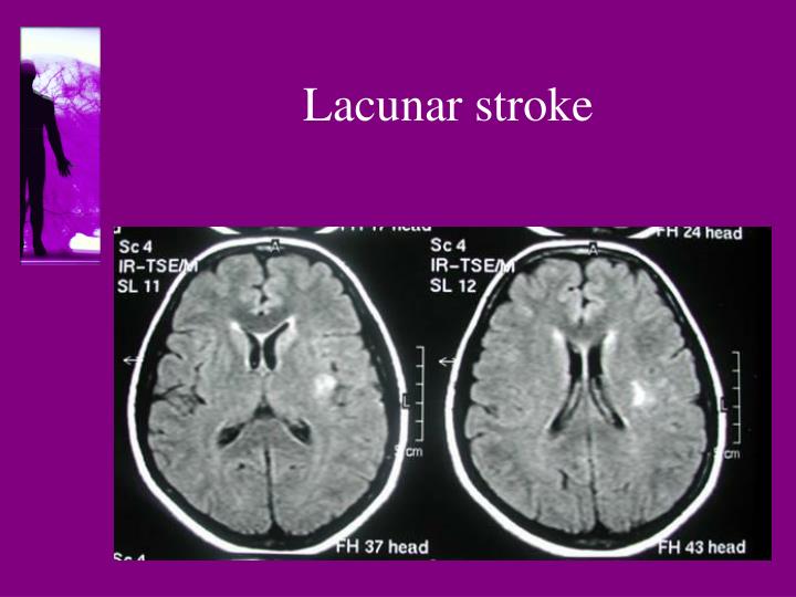 PPT - Antiplatelet and anticoagulant therapy in stroke prevention ...