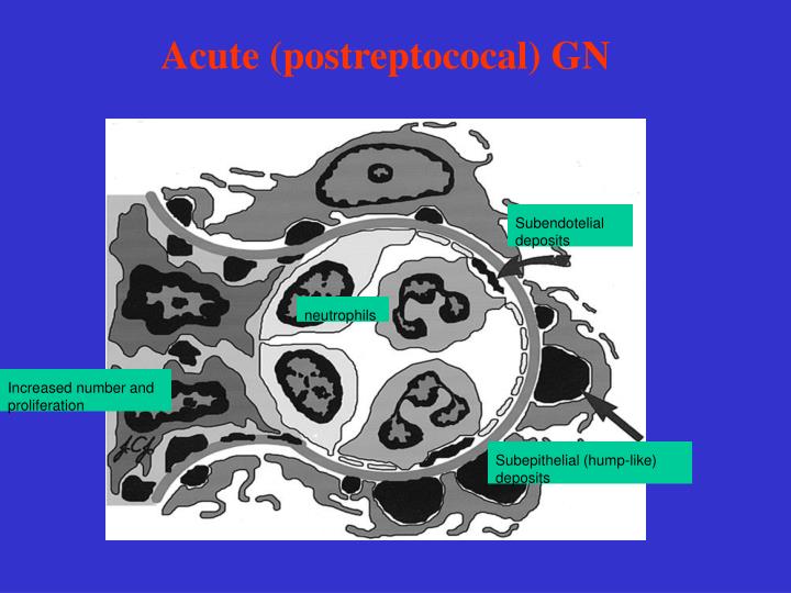PPT - Primary glomerulonephritides (GN) II Proliferative GN PowerPoint ...
