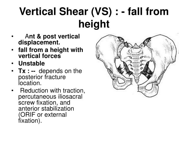 PPT - Pelvis fracture PowerPoint Presentation - ID:737949
