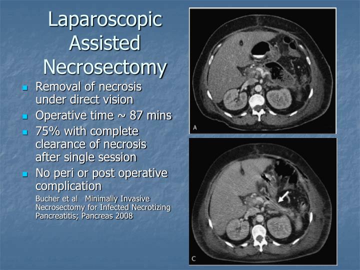 PPT - The Management of Acute Necrotizing Pancreatitis PowerPoint ...