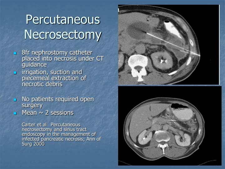 PPT - The Management of Acute Necrotizing Pancreatitis PowerPoint ...