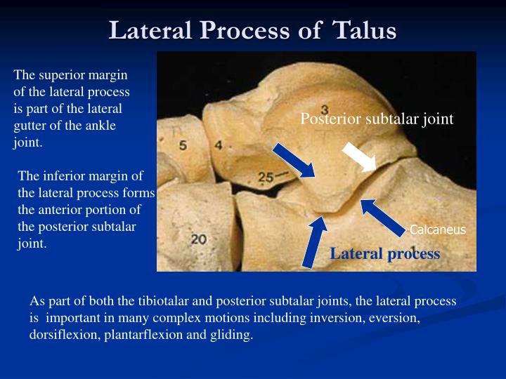 PPT - Fractures of the Lateral Process of the Talus: A Diagnostic ...