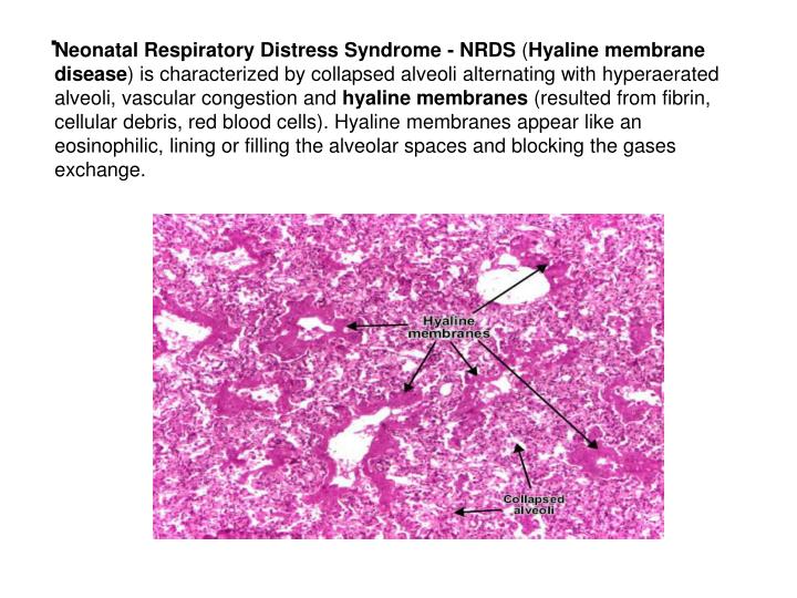PPT - Respiratory disorders PowerPoint Presentation - ID:745595