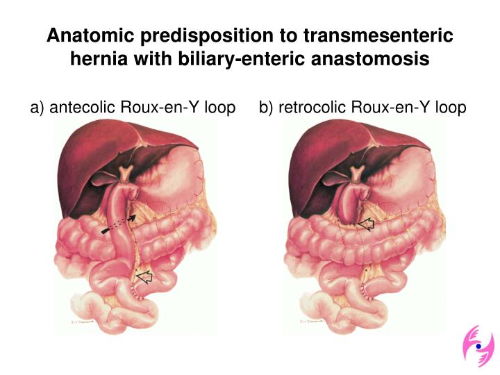 PPT - Internal Hernia – a brief review of its clinical features and ...