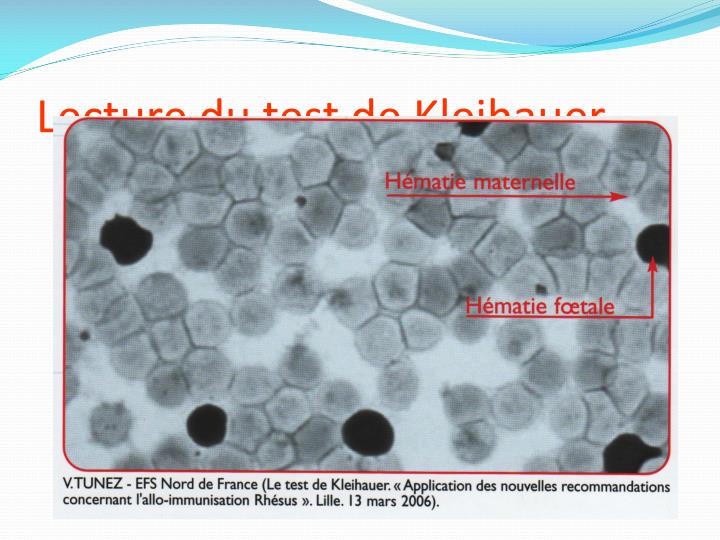 PPT - ANOMALIES DE QUANTITE DU LIQUIDE AMNIOTIQUE PowerPoint ...