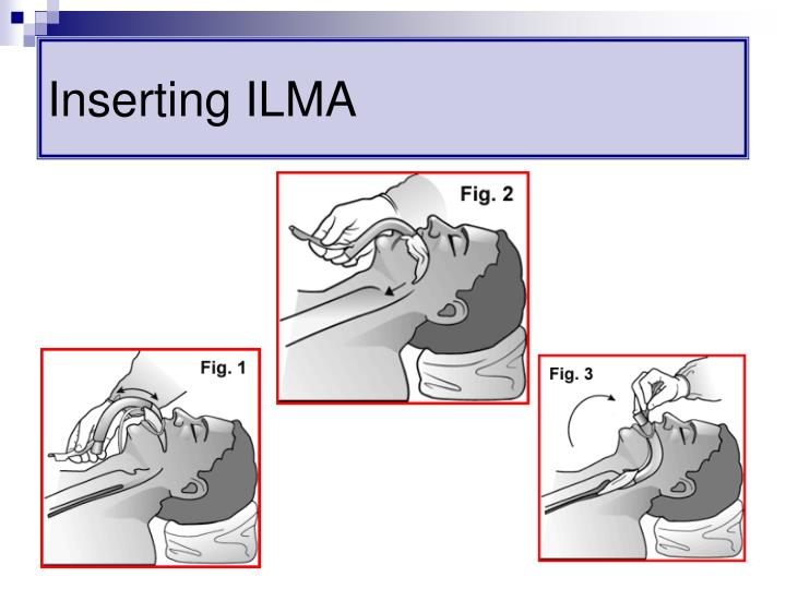 PPT - Airway Management in the Critically Ill PowerPoint Presentation ...