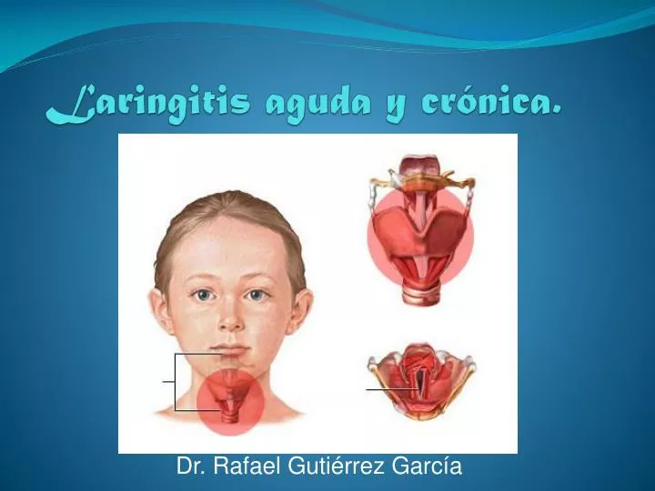 PPT - Laringitis aguda y crónica. PowerPoint Presentation - ID:752448