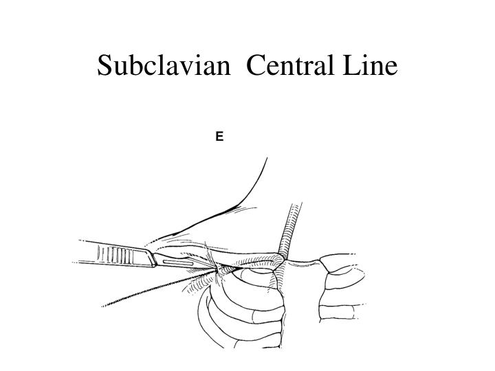 PPT - Central Venous Access Seldinger Guidewire Technique PowerPoint ...