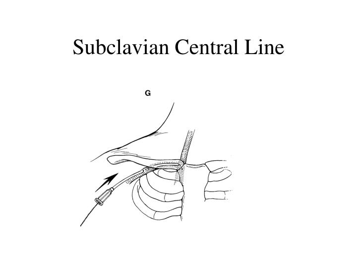 PPT - Central Venous Access Seldinger Guidewire Technique PowerPoint ...