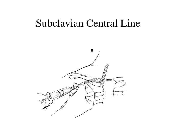 PPT - Central Venous Access Seldinger Guidewire Technique PowerPoint ...