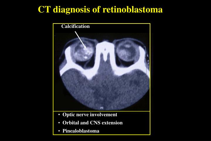 PPT - RETINOBLASTOMA PowerPoint Presentation - ID:753796
