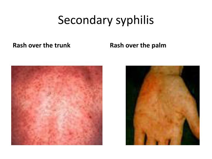 PPT - Syphilis PowerPoint Presentation - ID:755282