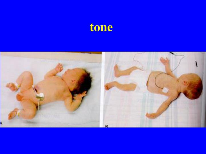 PPT - Same gestational age SGA AGA LGA PowerPoint Presentation - ID:757401