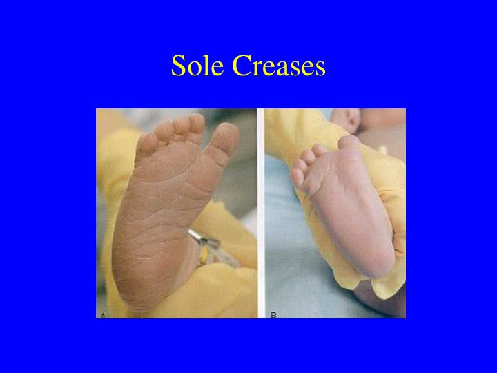 PPT - Same gestational age SGA AGA LGA PowerPoint Presentation - ID:757401