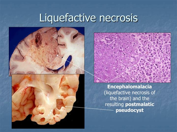 PPT - Cell injury:necrosis, apoptosis. Adaptations:atrophy, hypertrophy ...