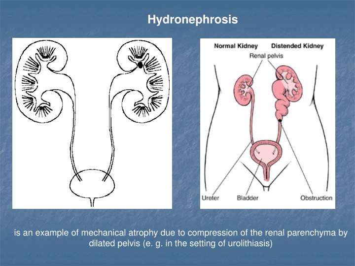 PPT - Cell injury:necrosis, apoptosis. Adaptations:atrophy, hypertrophy ...