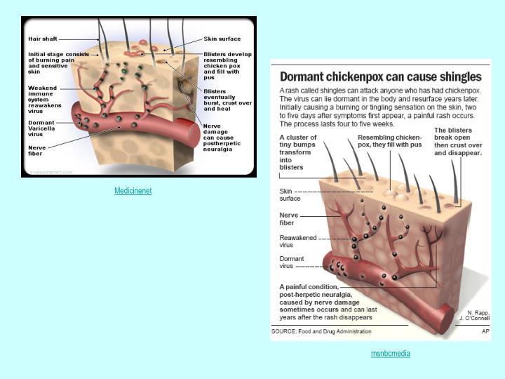 PPT - Shingles PowerPoint Presentation - ID:758448