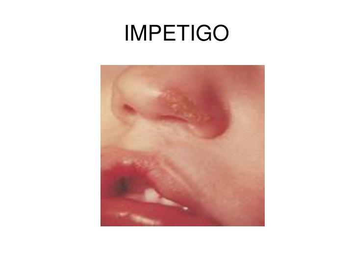 PPT - INFECTIOUS DISORDERS OF THE SKIN PowerPoint Presentation - ID:759599