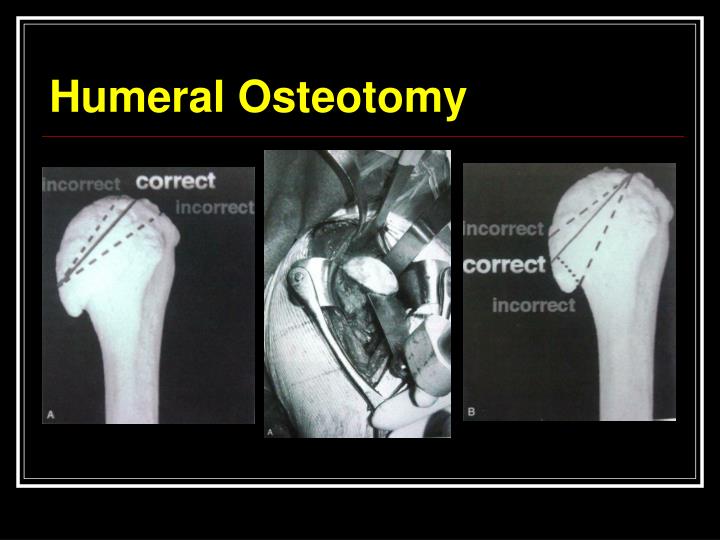 PPT - What is in Shoulder Arthroplasty ? PowerPoint Presentation - ID ...