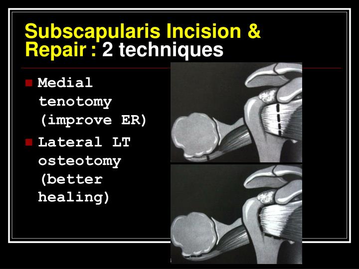 PPT - What is in Shoulder Arthroplasty ? PowerPoint Presentation - ID ...
