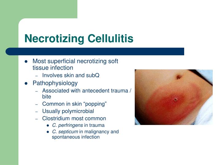 PPT - Soft Tissue Infections PowerPoint Presentation - ID:760835