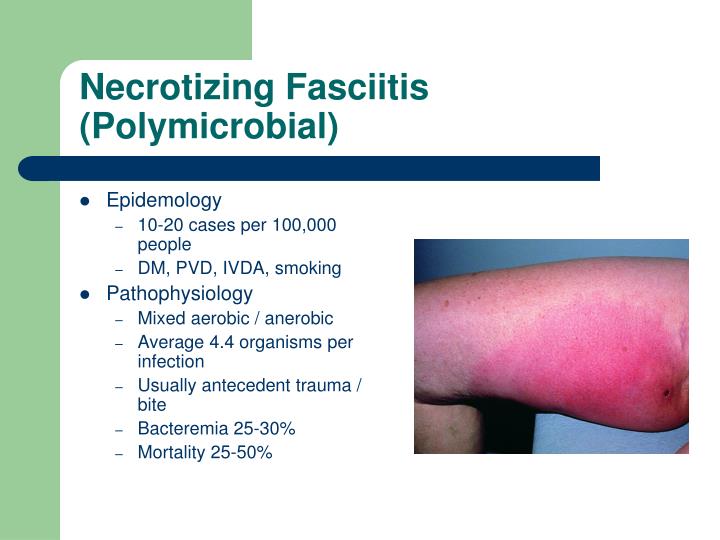PPT - Soft Tissue Infections PowerPoint Presentation - ID:760835