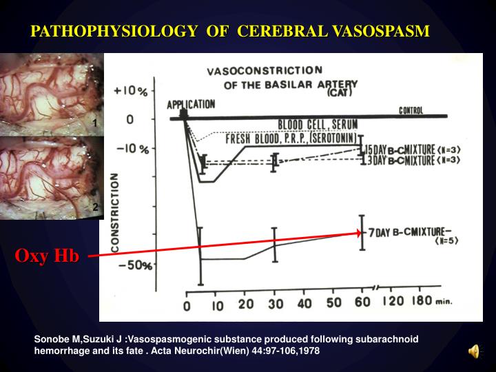 PPT - Cerebral Vasospasm post Subarachnoid Hemorrhage ...