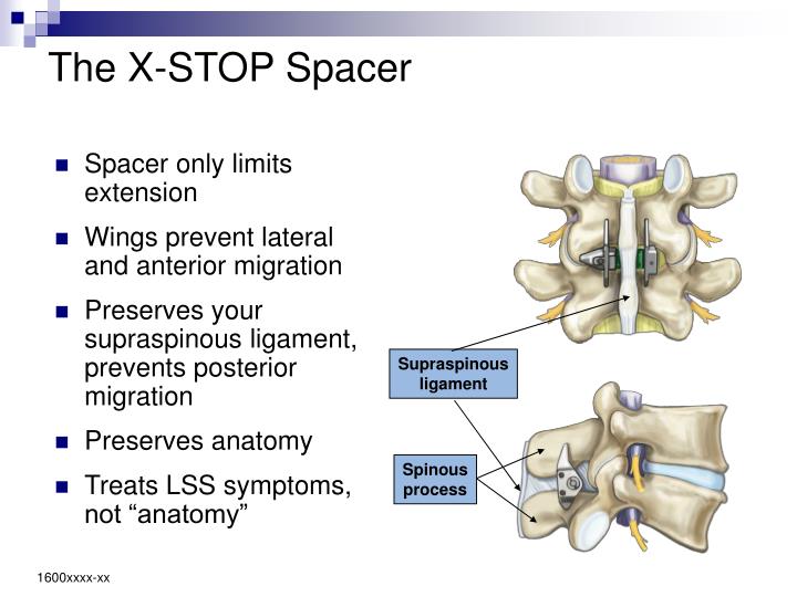 PPT - Lumbar Spinal Stenosis: Symptoms and Treatment PowerPoint ...