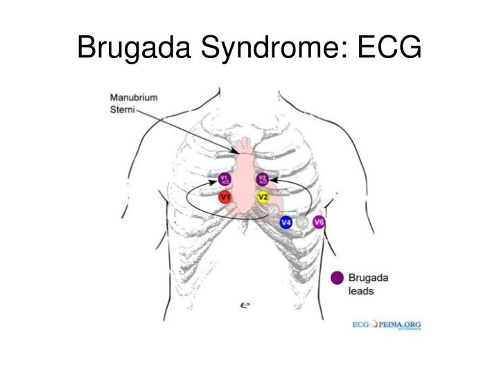 PPT - Brugada’s Syndrome and Sudden Cardiac Death PowerPoint ...