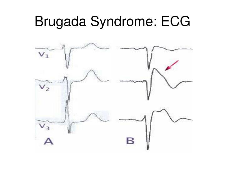 PPT - Brugada’s Syndrome and Sudden Cardiac Death PowerPoint ...