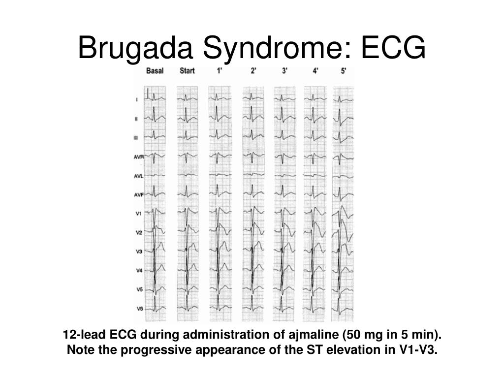 PPT - Brugada’s Syndrome and Sudden Cardiac Death PowerPoint ...