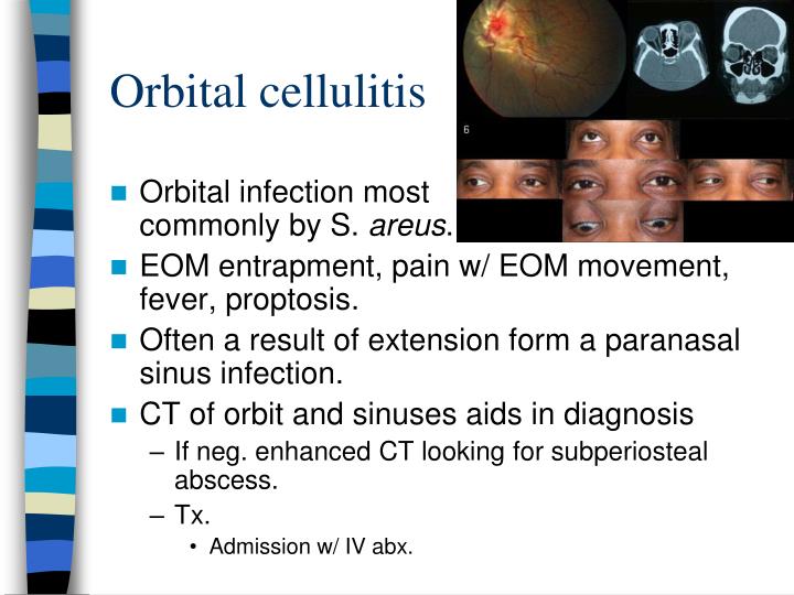 PPT - Ocular emergencies PowerPoint Presentation - ID:764166