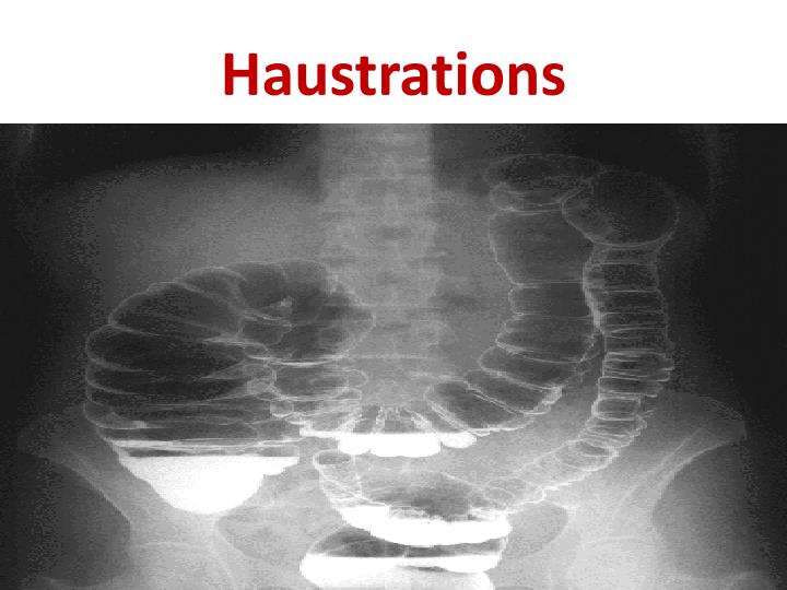 PPT - Intestinal Obstruction PowerPoint Presentation - ID:764183
