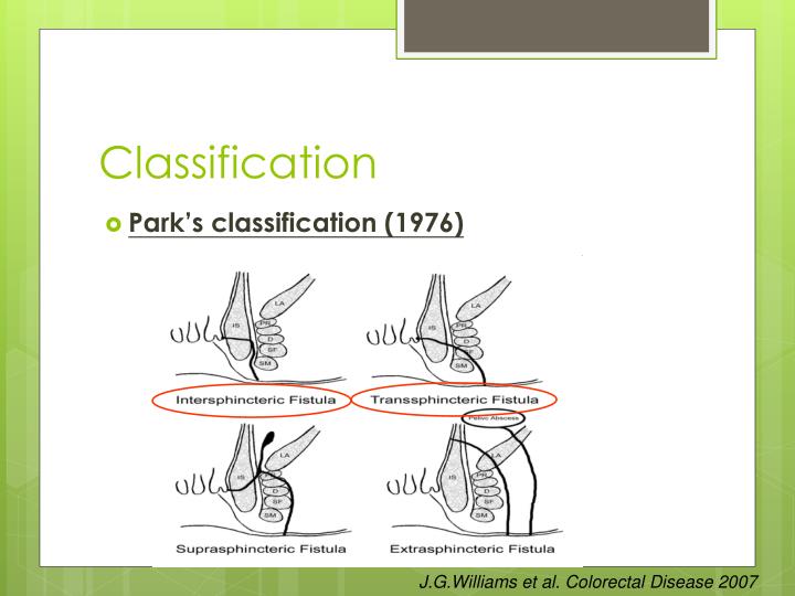 PPT - The Best Surgical Treatment for Fistula-in-ano PowerPoint ...