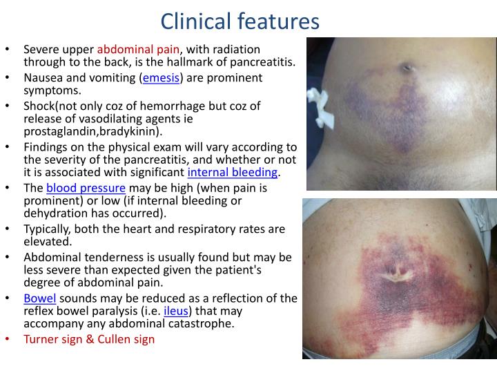 PPT - Pancreatitis PowerPoint Presentation - ID:776273