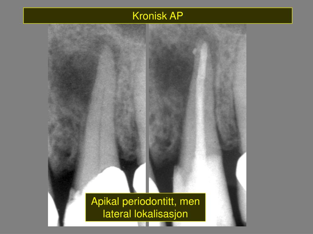 PPT - Introduksjon: Pulpitt og apikal periodontitt: klinikk og ...