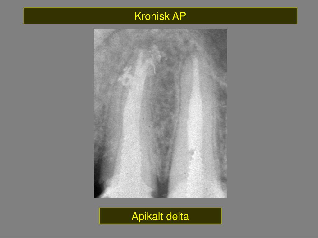 PPT - Introduksjon: Pulpitt og apikal periodontitt: klinikk og ...