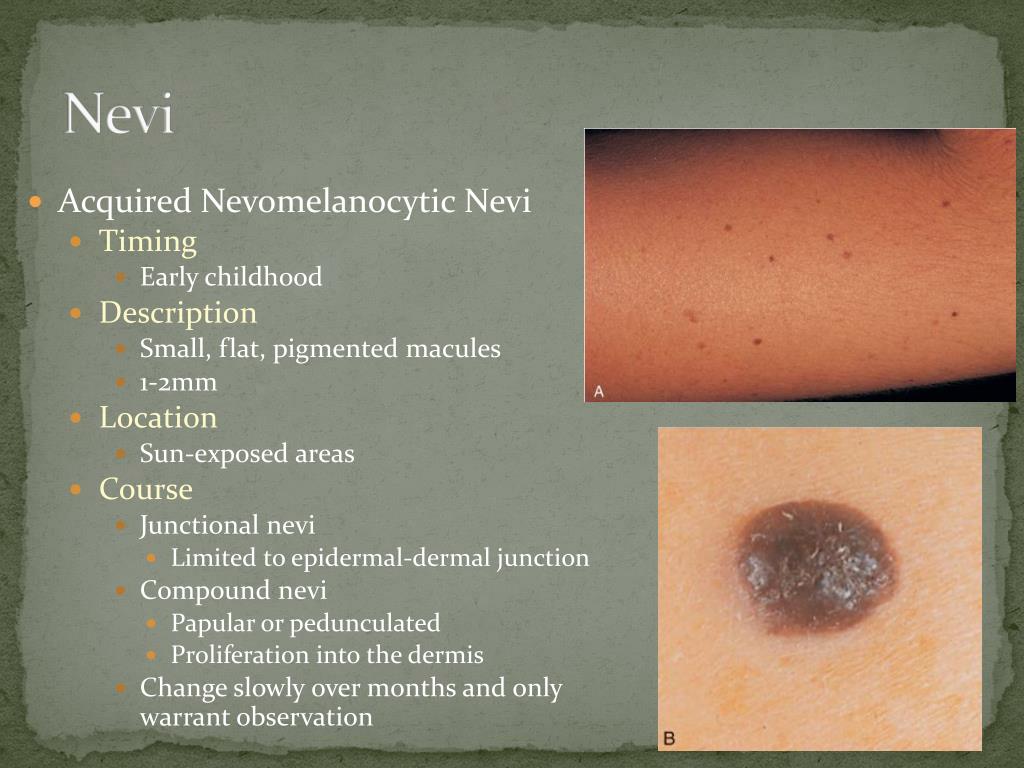 Ppt Hemangiomas And Vascular Malformations Powerpoint Presentation