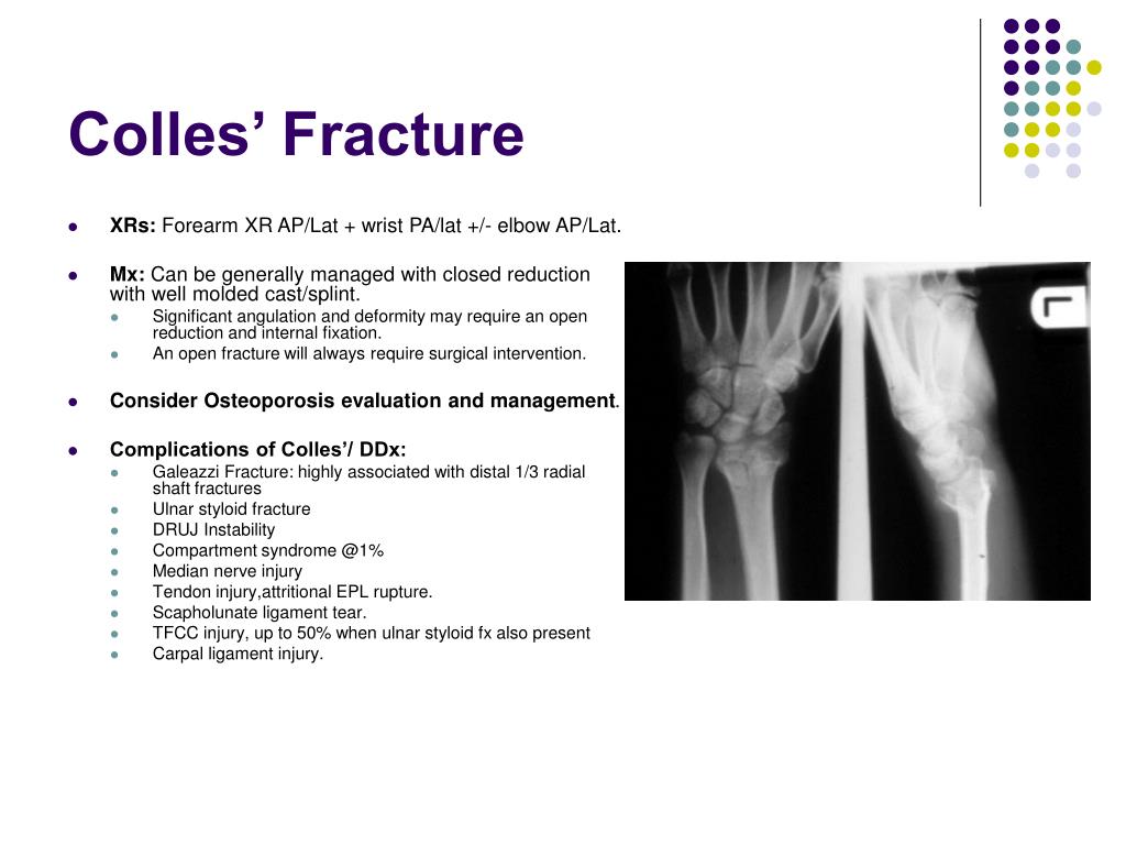 Ppt Forearm And Wrist Fractures Powerpoint Presentation Free