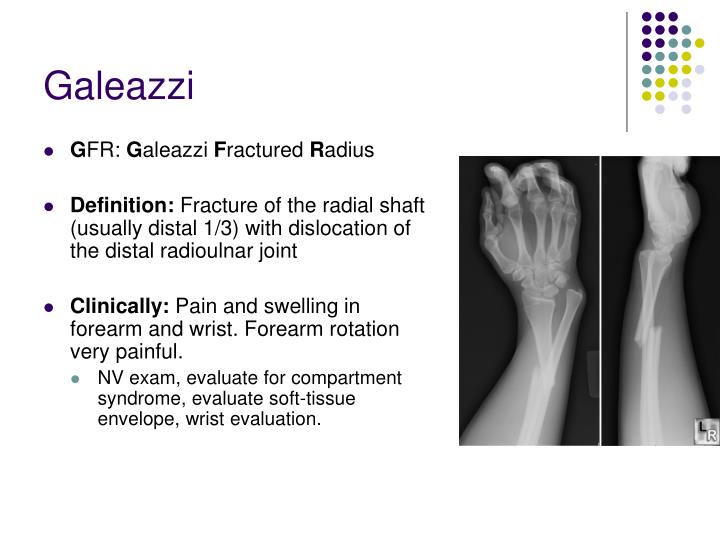 PPT - Forearm and Wrist Fractures PowerPoint Presentation - ID:788063