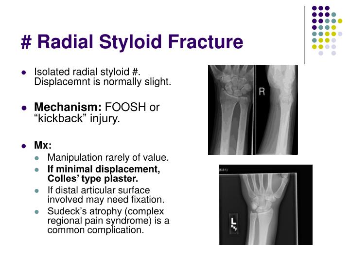 Radial Styloid Process