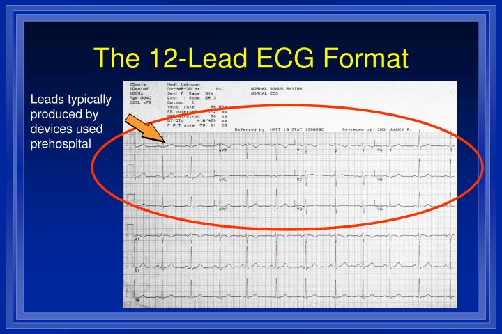 PPT - Essentials of 12 Lead ECG Interpretation PowerPoint Presentation ...