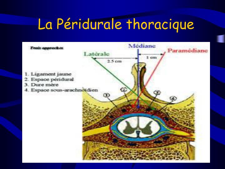 PPT - Anesthésie loco-régionale PowerPoint Presentation - ID:793301