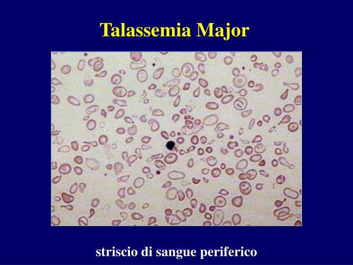 PPT - La Talassemia PowerPoint Presentation - ID:794679