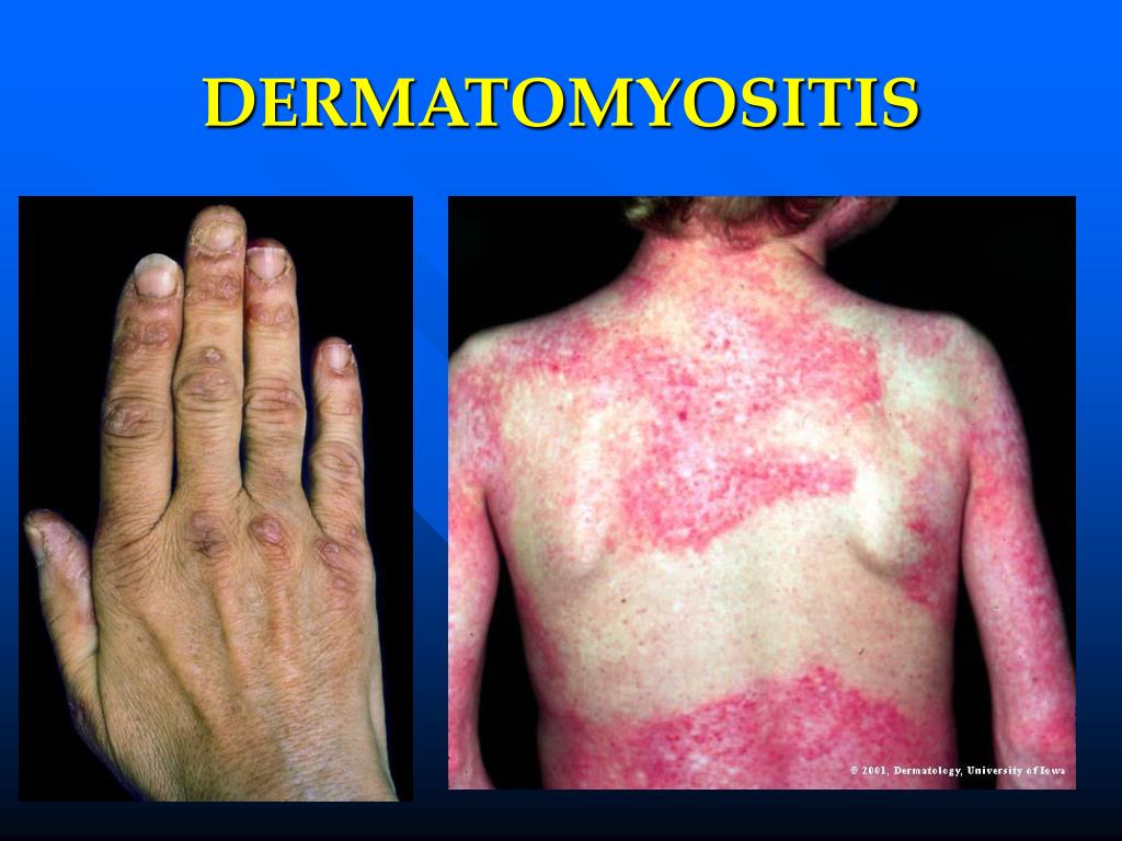 PPT - DERMATOLOGICAL MANIFESTATIONS OF SYSTEMIC DISEASE PowerPoint ...
