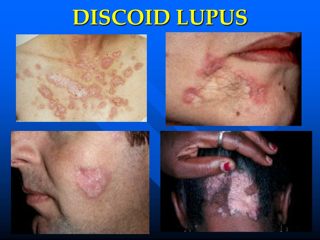 PPT - DERMATOLOGICAL MANIFESTATIONS OF SYSTEMIC DISEASE PowerPoint ...